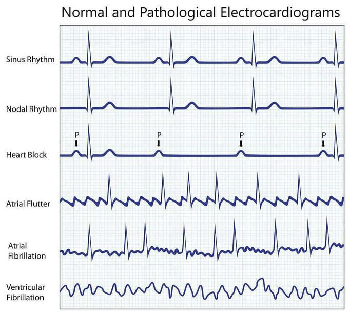 Normal and pathological ECG - MEDizzy