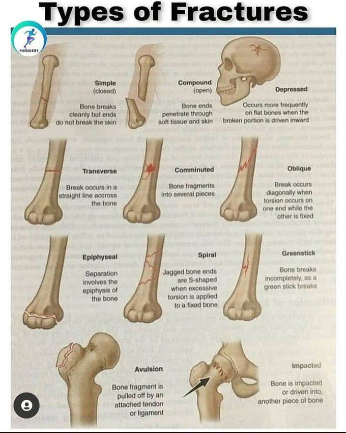 Types of fractures - MEDizzy