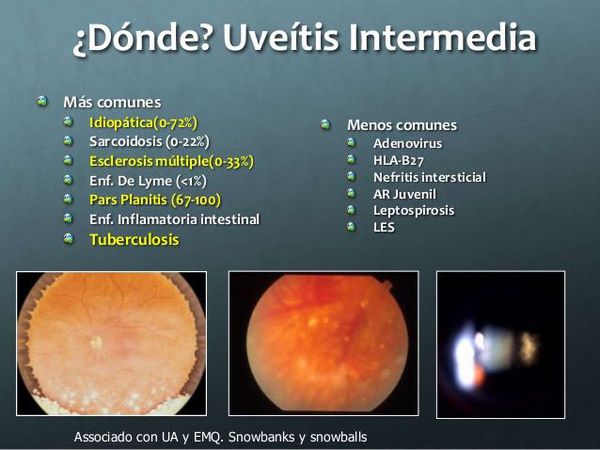 Uveitis Intermedia