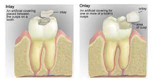 Inlays vs onlays - MEDizzy