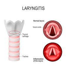 Why laryngitis occurs? - MEDizzy