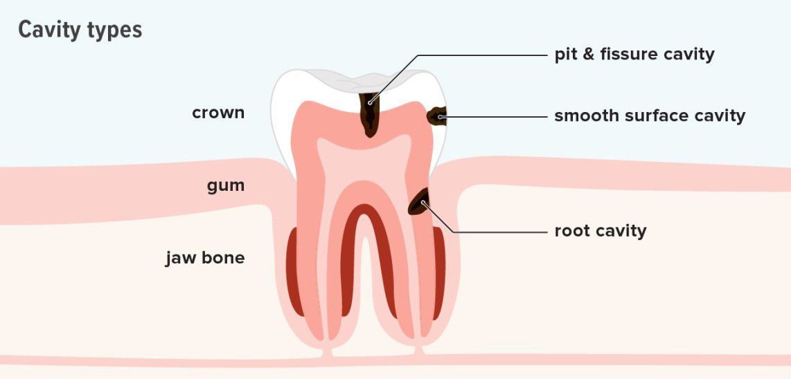 Root Cavities - MEDizzy