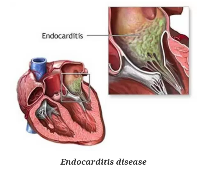 Endocarditis - MEDizzy