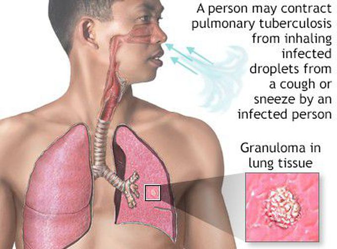 Pulmonary Tuberculosis - MEDizzy