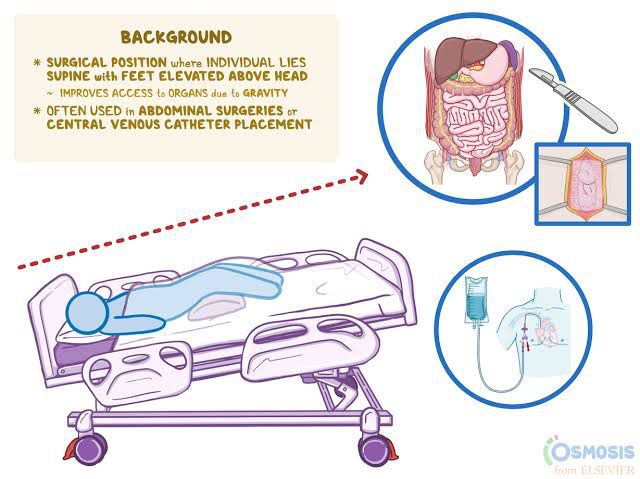 Trendelenburg position - MEDizzy