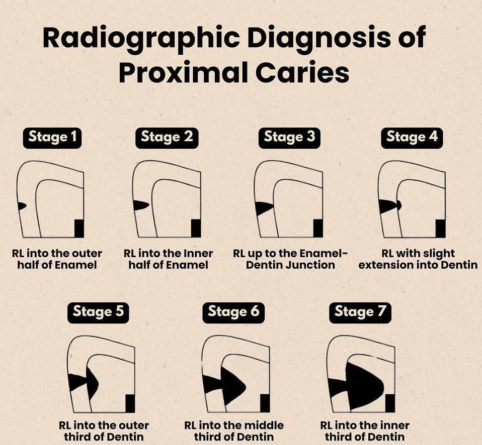 Radiographic Diagnosis of Proximal Caries - MEDizzy