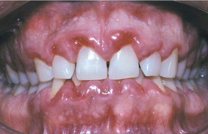 Mouth Breathing–Related Gingivitis - MEDizzy