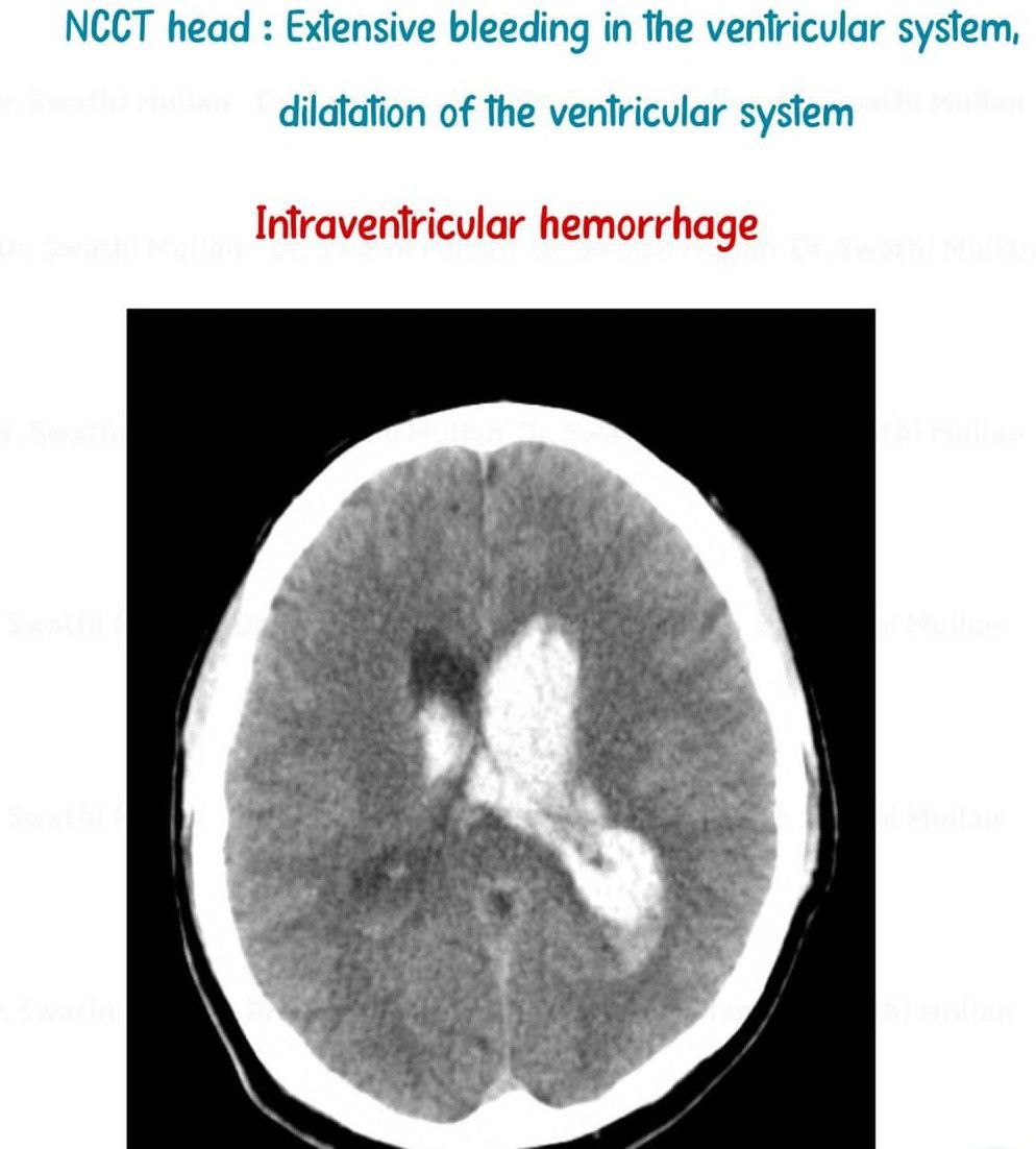 Intraventricular Hemorrhage MEDizzy
