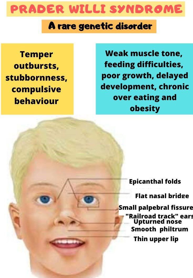 Prader Willi Syndrome Facial Features