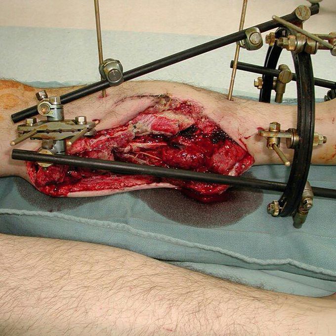 External fixation of an open fracture of the leg!! - MEDizzy