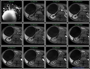 MR Abdominal Imaging – Primovist/Eovist for cyst @ Siemens - MEDizzy