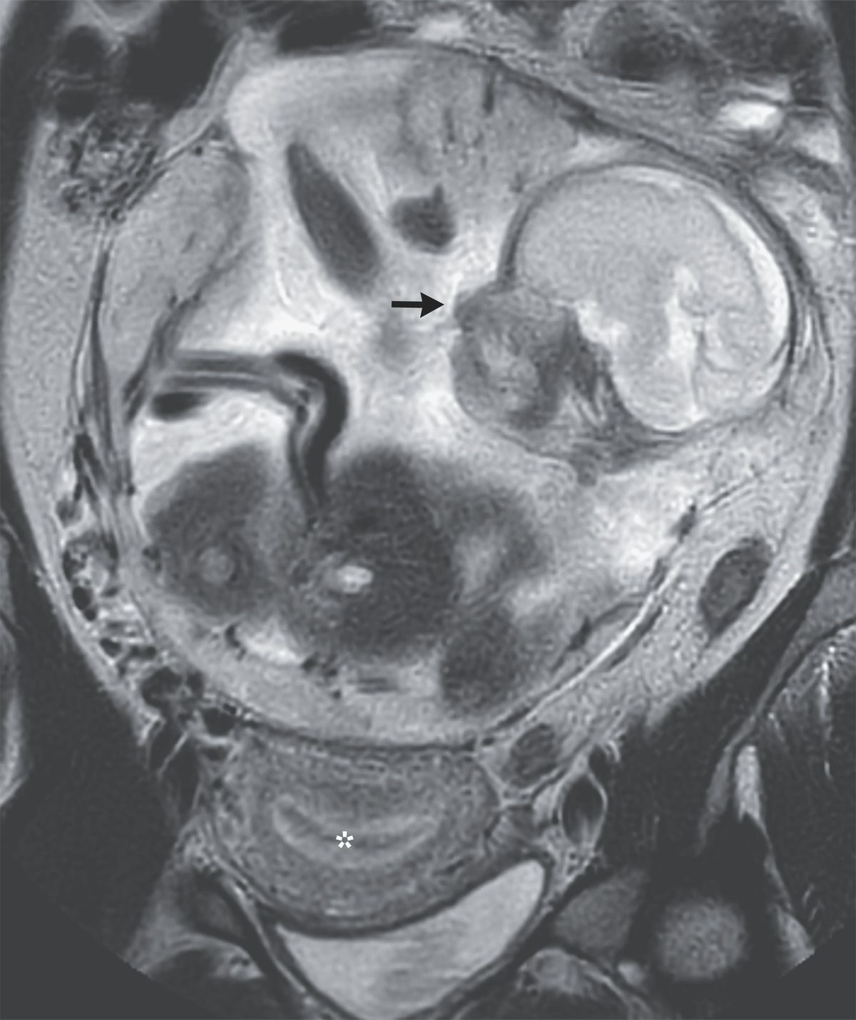 Abdominal Ectopic Pregnancy MEDizzy