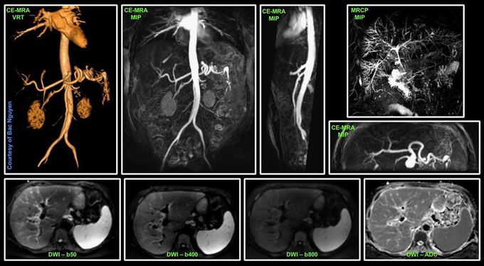 Liver specific contrast agent Primovist/Eovist @ Siemens 3T - MEDizzy
