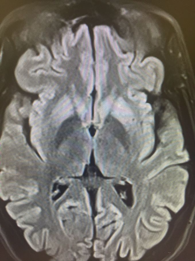 Typical MRI of ... - MEDizzy