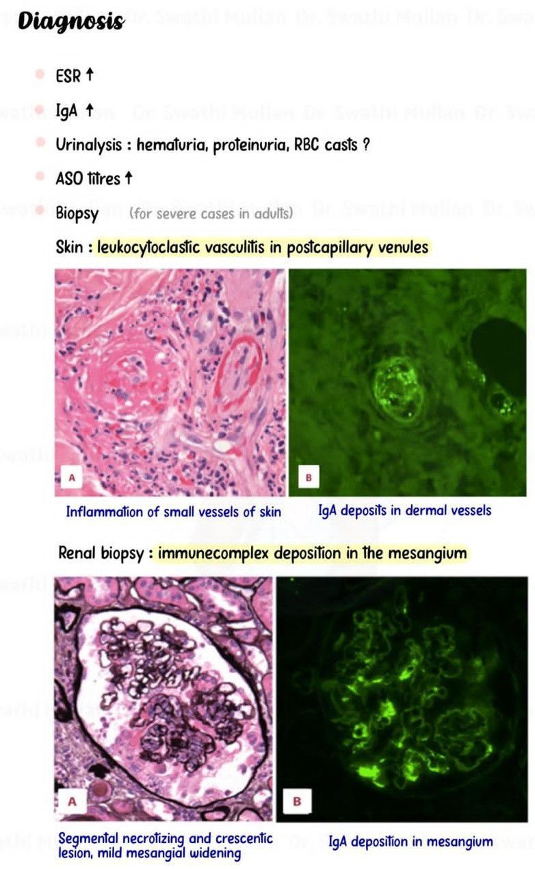 Henoch Schonlein Purpura II - MEDizzy