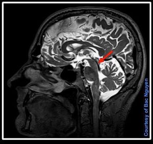An easy technique to confirm CSF flow within aqueduct @ - MEDizzy