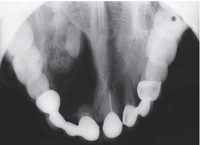 Calcifying odontogenic cyst - MEDizzy