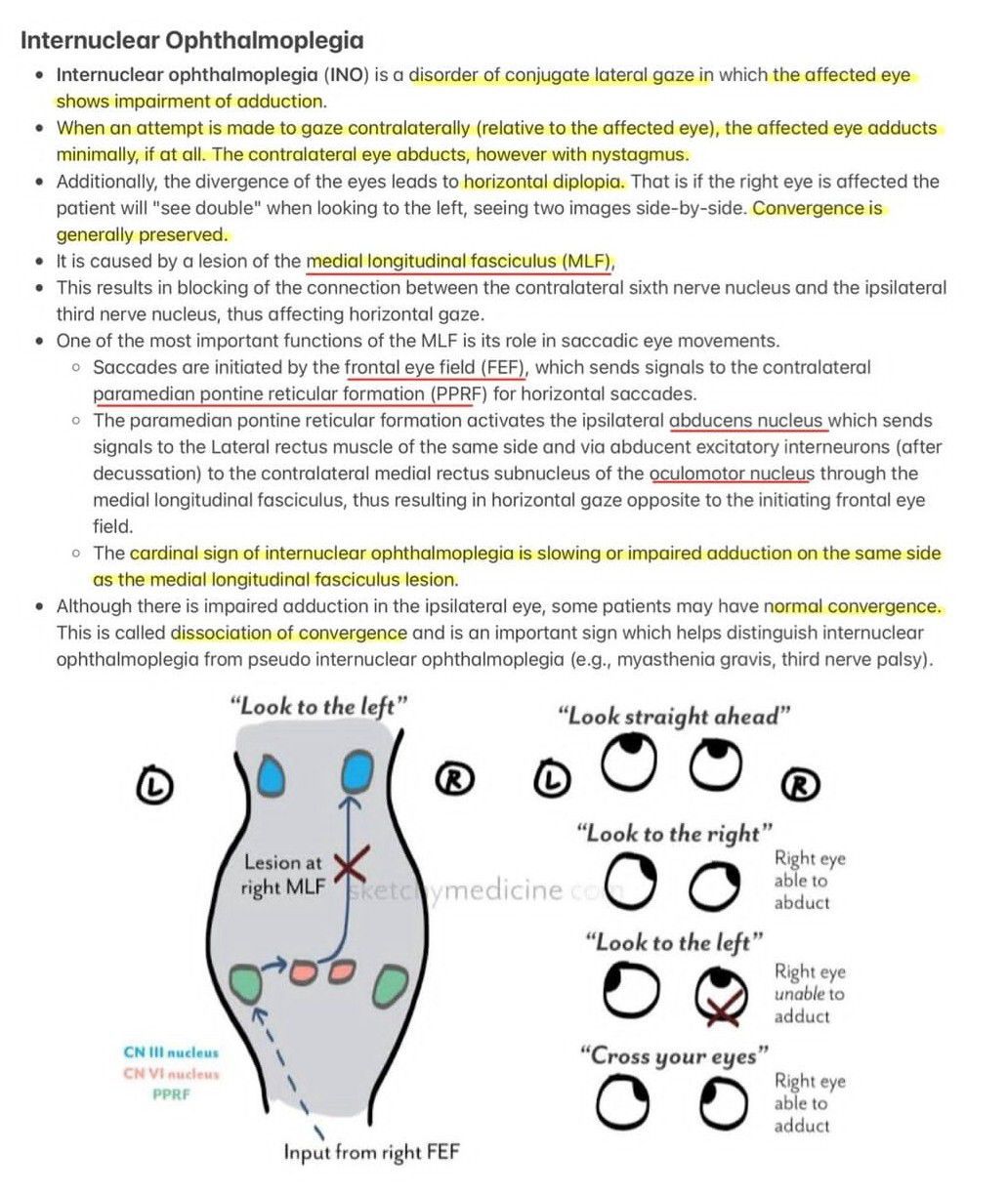 Internuclear Ophthalmoplegia Bilateral Internuclear Ophthalmoplegia In