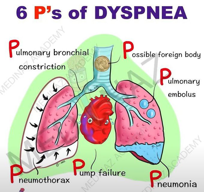 6 Ps of Dyspnea - MEDizzy