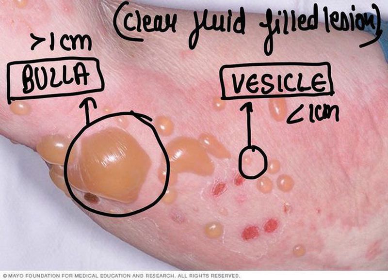vesicle bulla