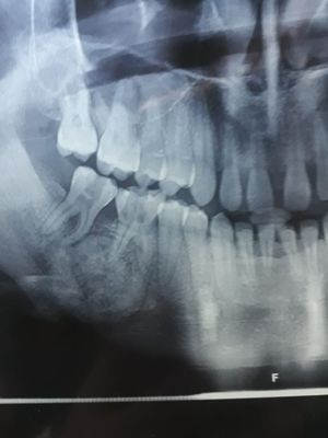 Bone cyst - MEDizzy