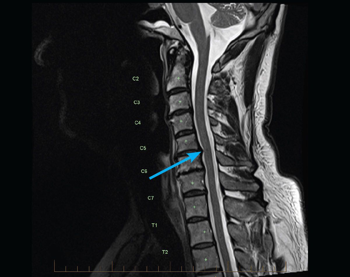 Cardinal Features of Cervical Radiculopathy - MEDizzy