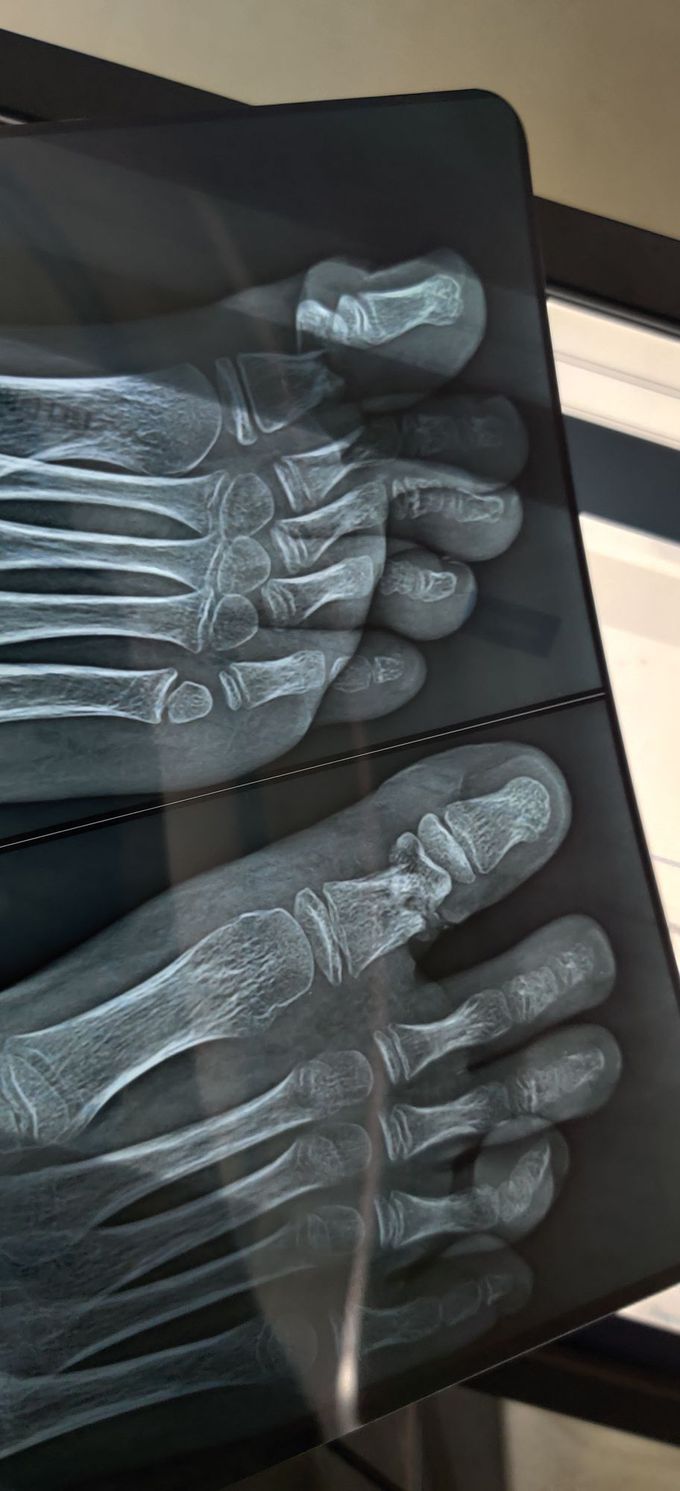 Fracture 1st Phalanx - MEDizzy