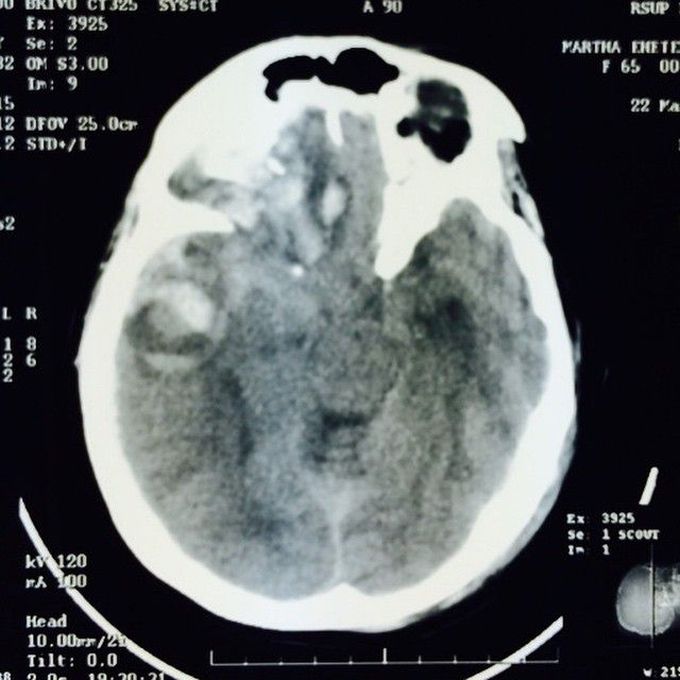 Brain contusion - MEDizzy