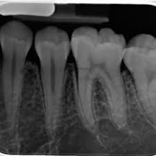 Periapical radiograph - MEDizzy