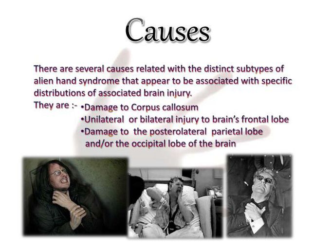 Alien Hand Syndrome