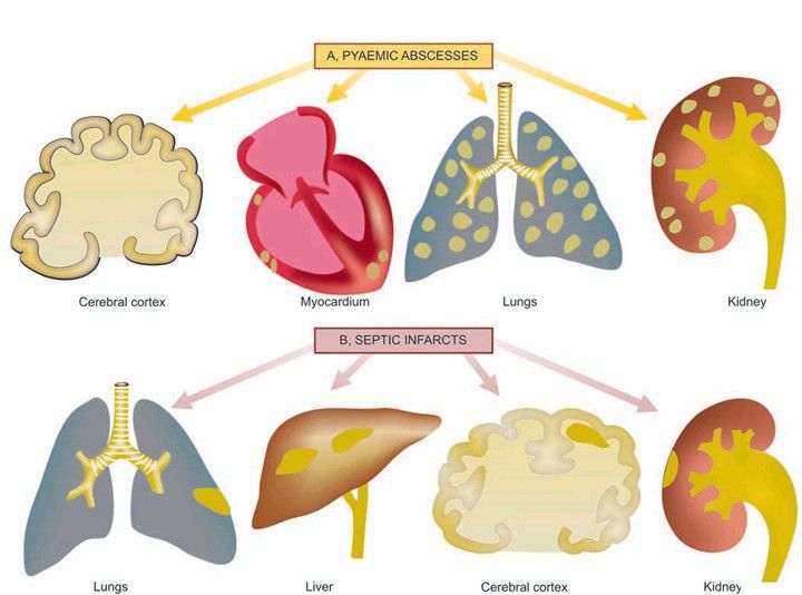 Pyaemia - MEDizzy