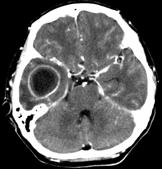 Temporal lobe abscess - MEDizzy