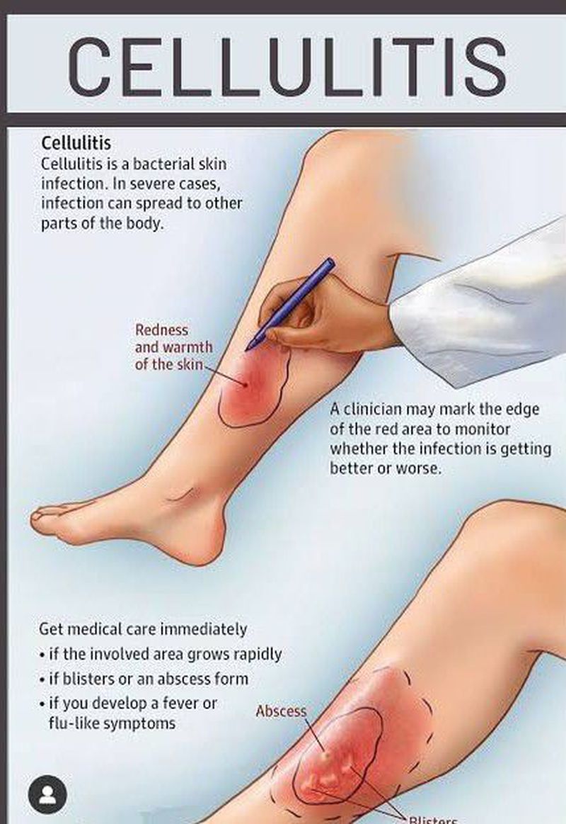 Cellulitis Infection