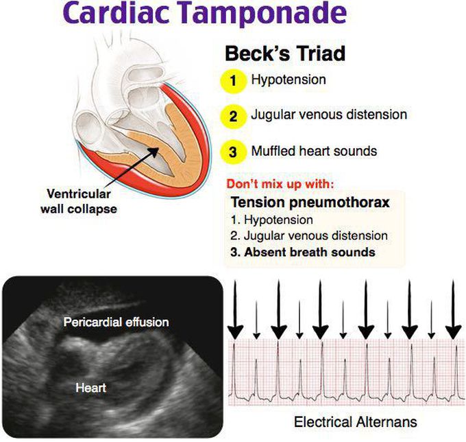 Cardiac Tamponade - MEDizzy