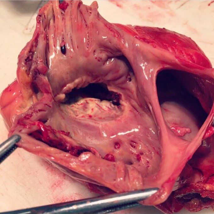 Atrial Septal Defect - MEDizzy