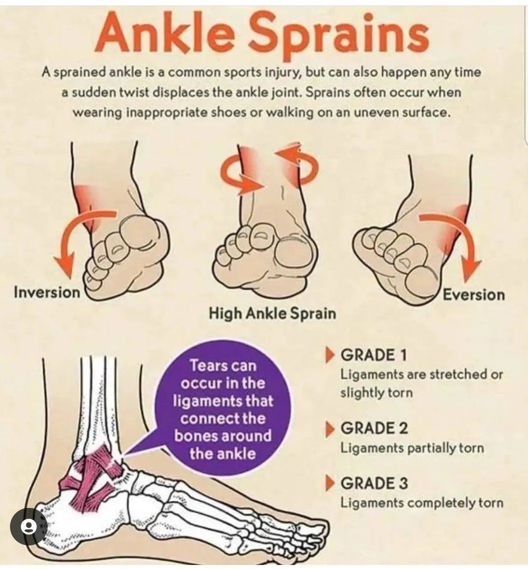 Ankle Sprain - MEDizzy