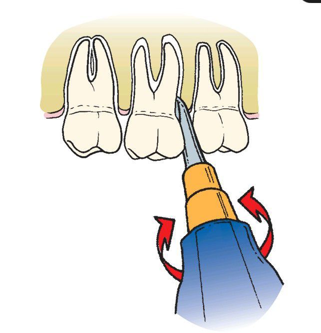 Luxation of tooth - MEDizzy