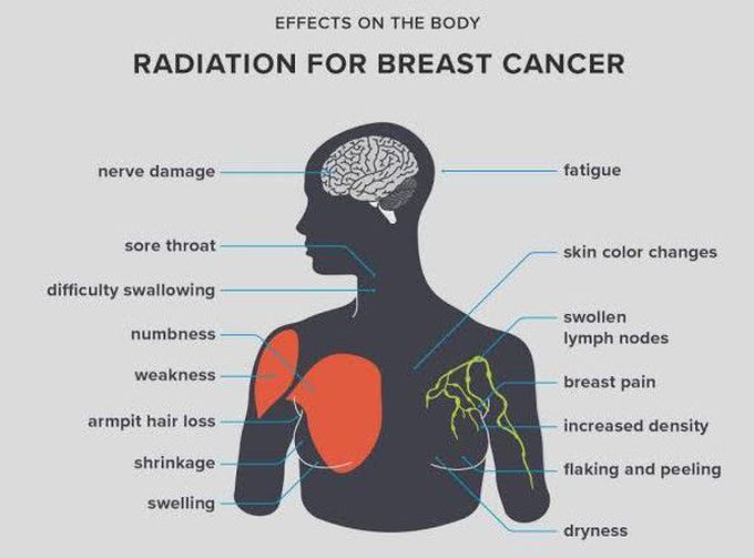 Effects of radiation on breast cancer treatment - MEDizzy