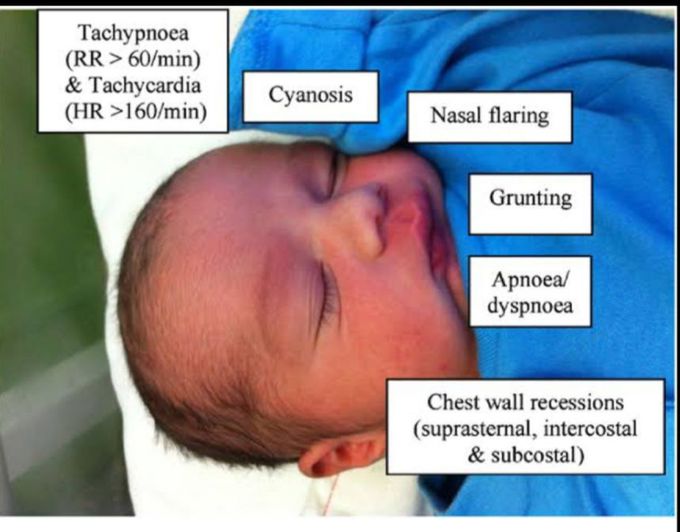 Newborn Respiratory Distress Syndrome Newborn Respiratory MEDizzy