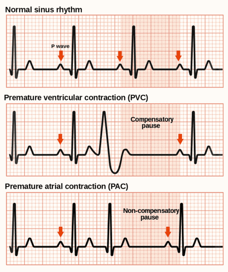 Premature Atrial Contraction Vertical Emojiekg Emotions Free Emoji