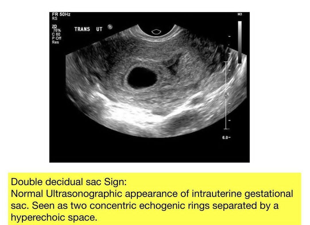 Double Decidual Sac Sign - MEDizzy