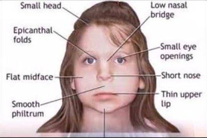 These are the symptoms of Miller dieker syndrome - MEDizzy