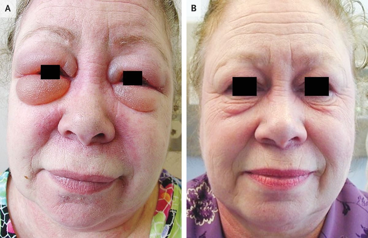Periorbital Edema In Dermatomyositis MEDizzy
