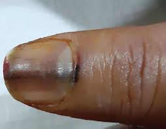 Hutchinson sign - MEDizzy