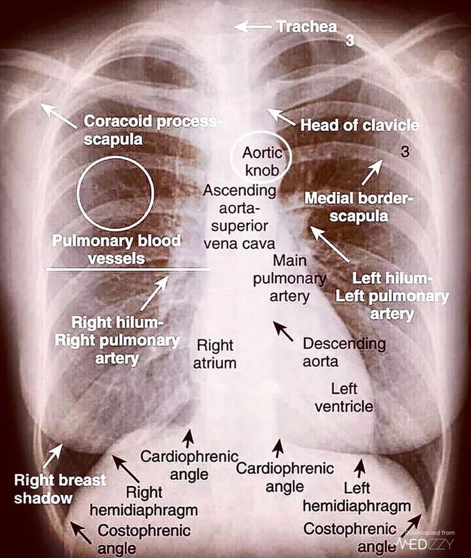 Chest X-ray - MEDizzy