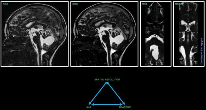 Fast CISS approach for ventricles of the brain @ Siemens - MEDizzy