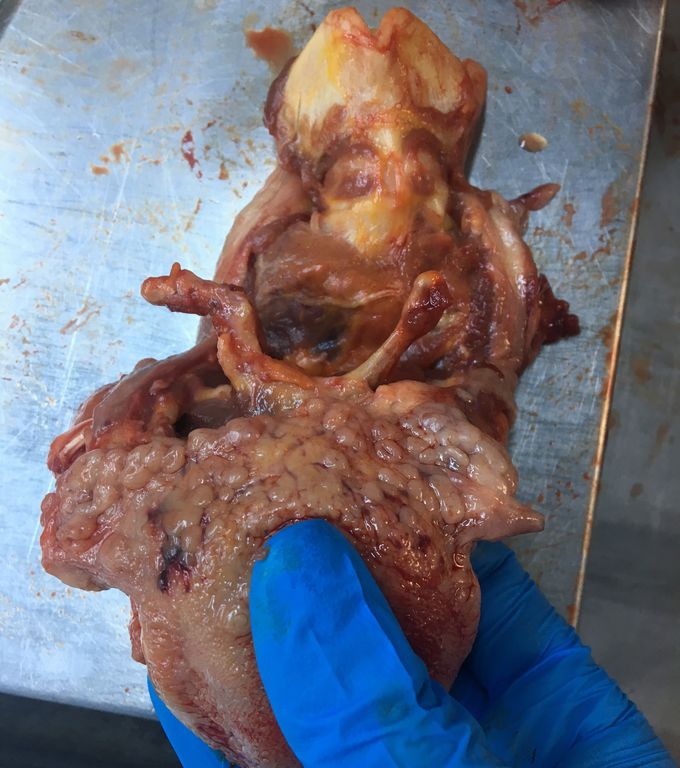 Hyoid bone fracture - MEDizzy