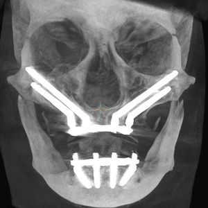 When you've got metals aligned in your mouth that grants you - MEDizzy