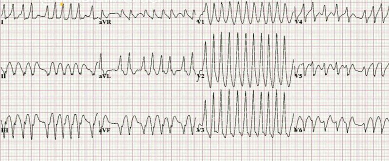 Arrhythmia - MEDizzy
