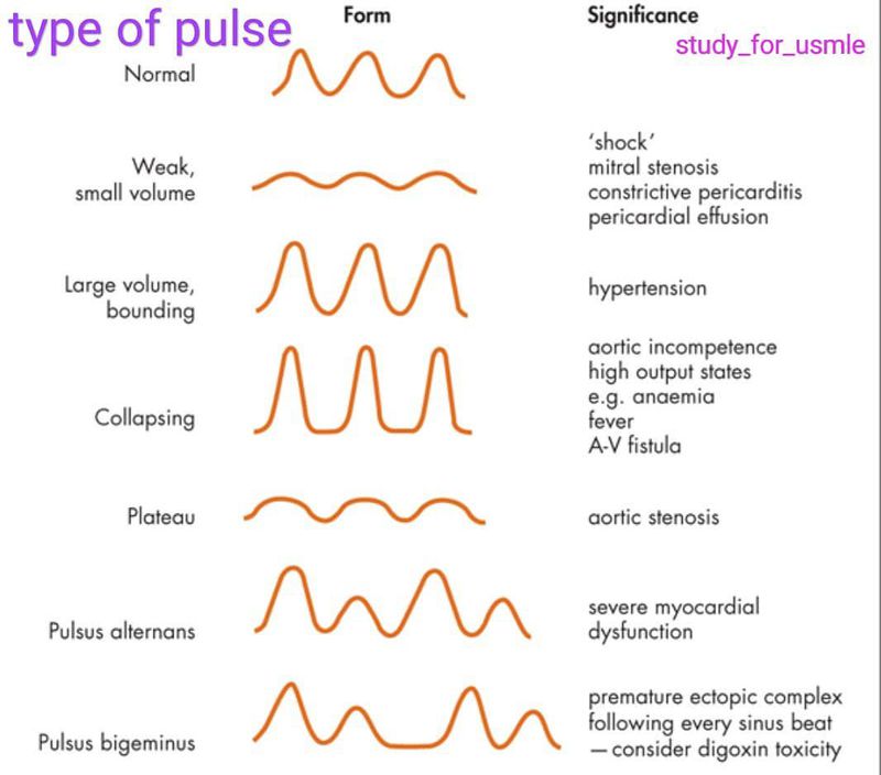 alternans pulsus